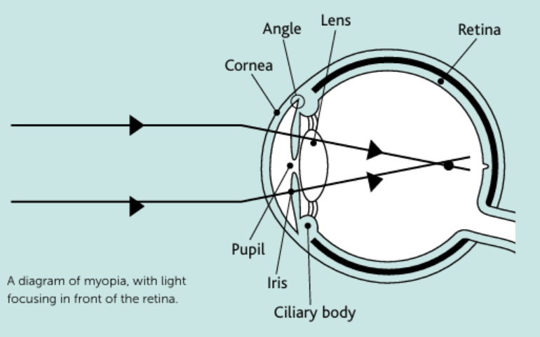 Myopia Management - Golding & Maud EyeCare